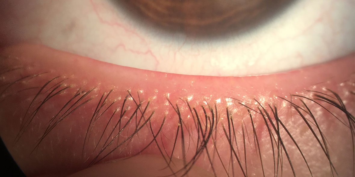 Blefarite – Dr. Paulo Freitas da Costa - Especialista de Oftalmologia e ...